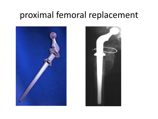 Hip Periprosthetic Fracture.pptx