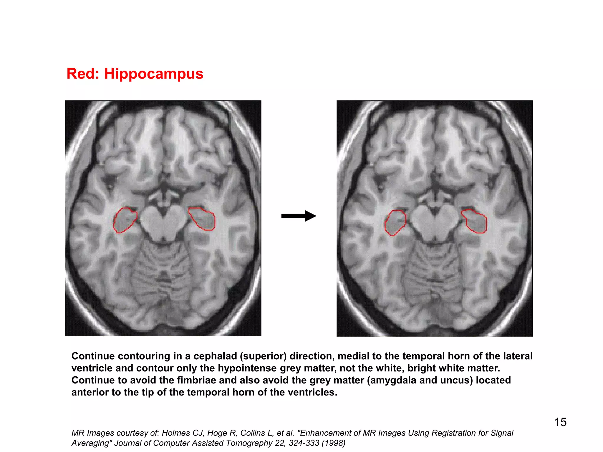 HIPPOCAMPUS TARGET DELINEATION | PPT