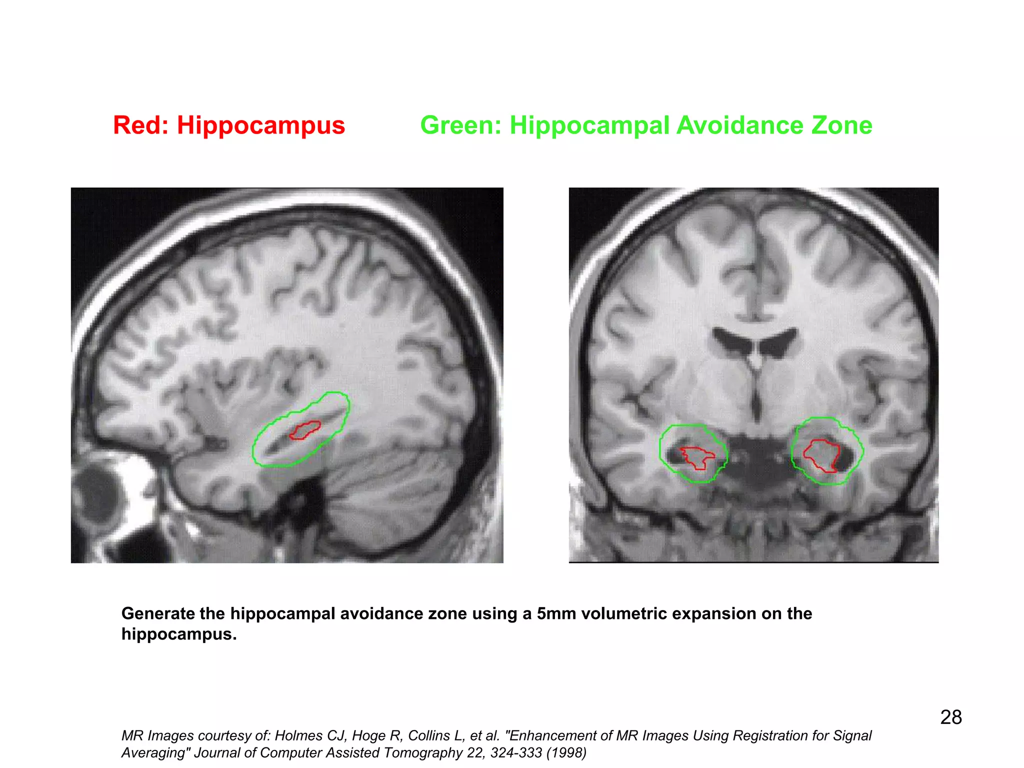 HIPPOCAMPUS TARGET DELINEATION | PPT