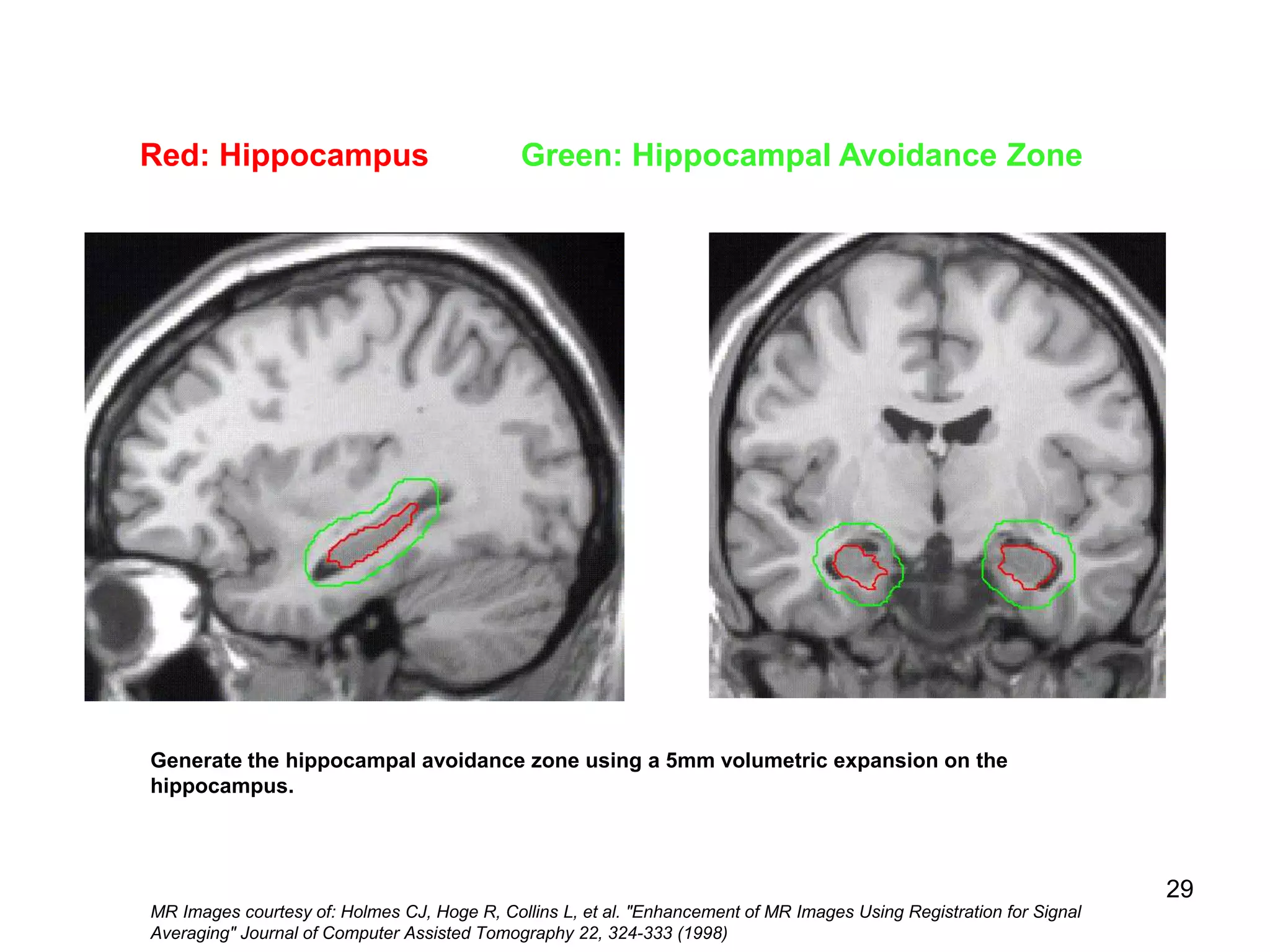 HIPPOCAMPUS TARGET DELINEATION | PPT