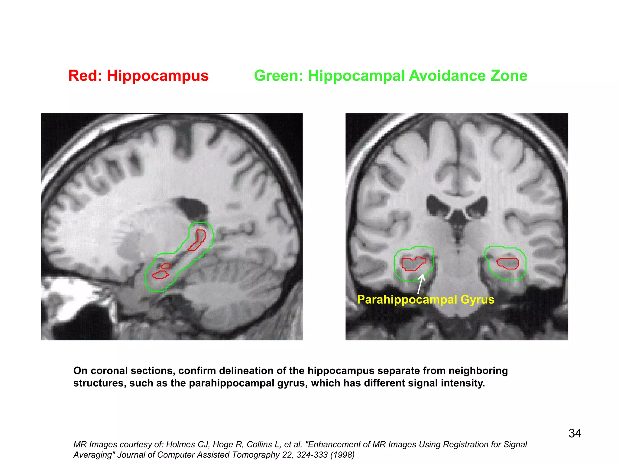 HIPPOCAMPUS TARGET DELINEATION | PPT