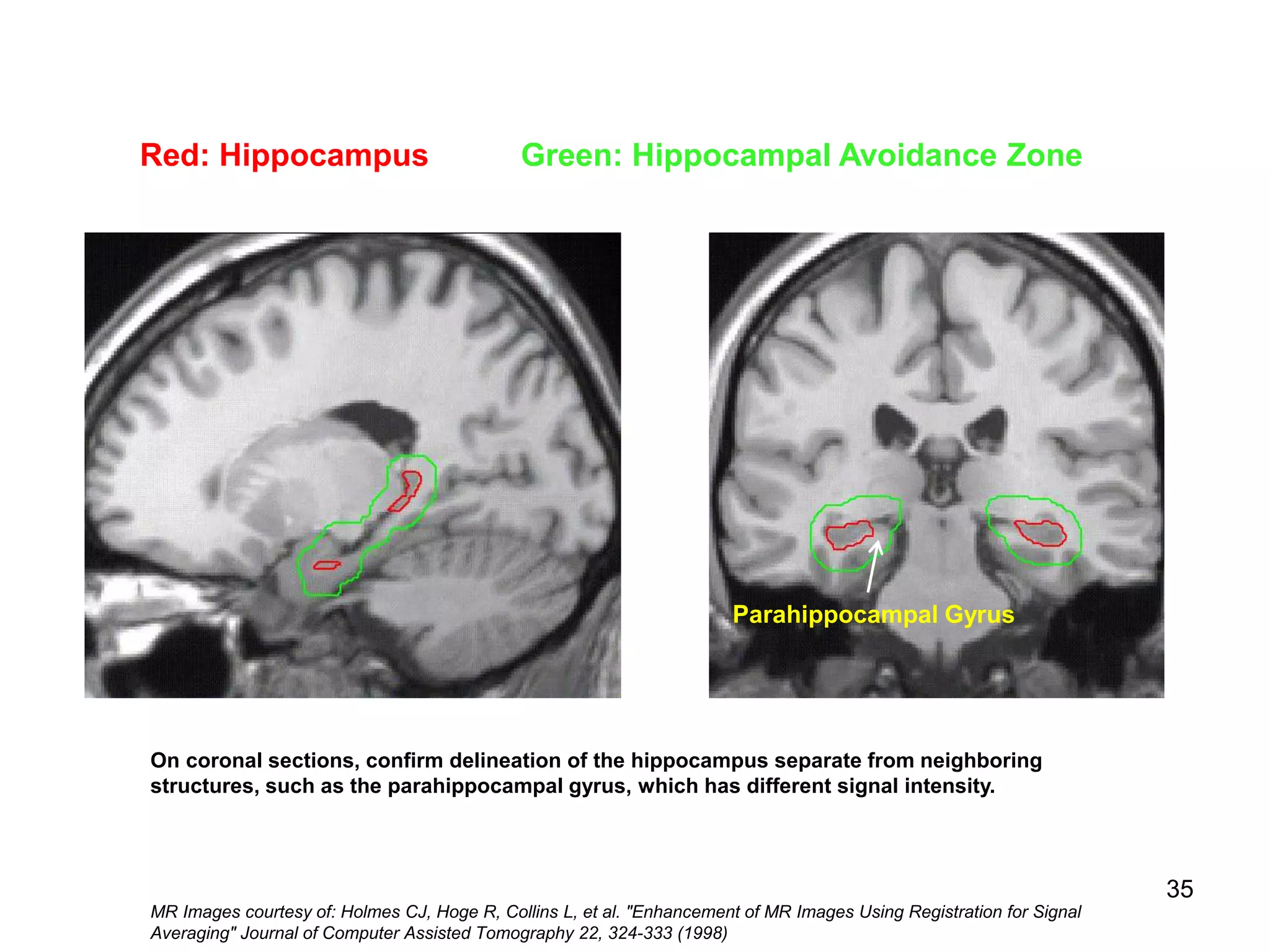 HIPPOCAMPUS TARGET DELINEATION | PPT
