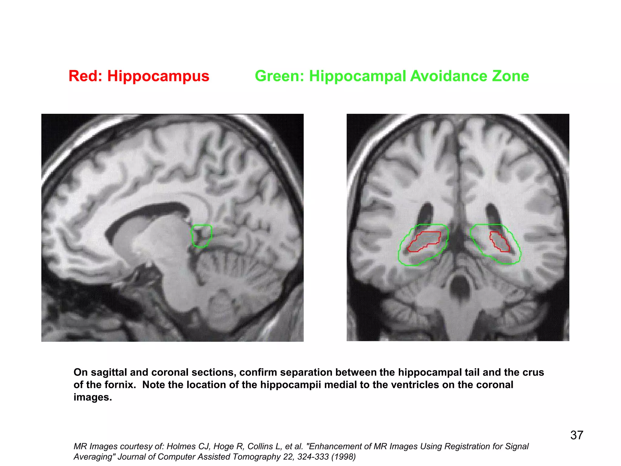 HIPPOCAMPUS TARGET DELINEATION | PPT