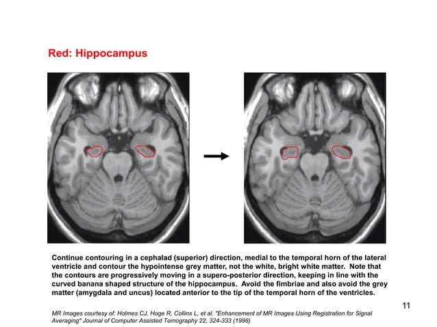 HIPPOCAMPUS TARGET DELINEATION | PPT