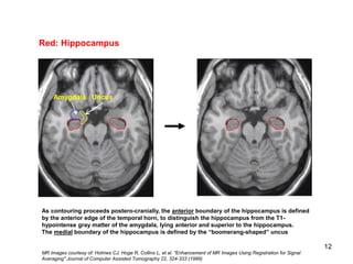 HIPPOCAMPUS TARGET DELINEATION | PPT