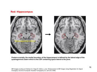 HIPPOCAMPUS TARGET DELINEATION | PPT