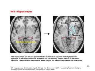 HIPPOCAMPUS TARGET DELINEATION | PPT