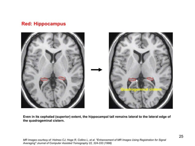HIPPOCAMPUS TARGET DELINEATION | PPT