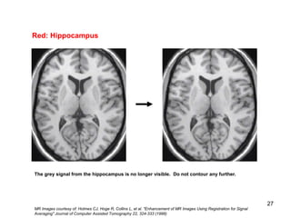 HIPPOCAMPUS TARGET DELINEATION | PPT