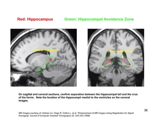 HIPPOCAMPUS TARGET DELINEATION | PPT