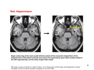 HIPPOCAMPUS TARGET DELINEATION | PPT