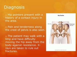 Hip pointer presentation em and holly[1] | PPTX