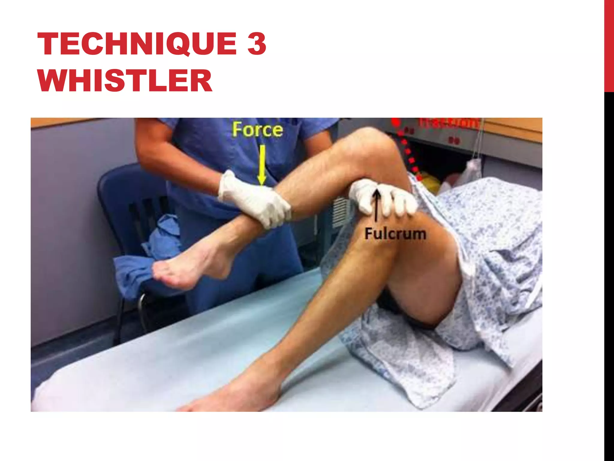 Hip Reduction Techniques | PPTX