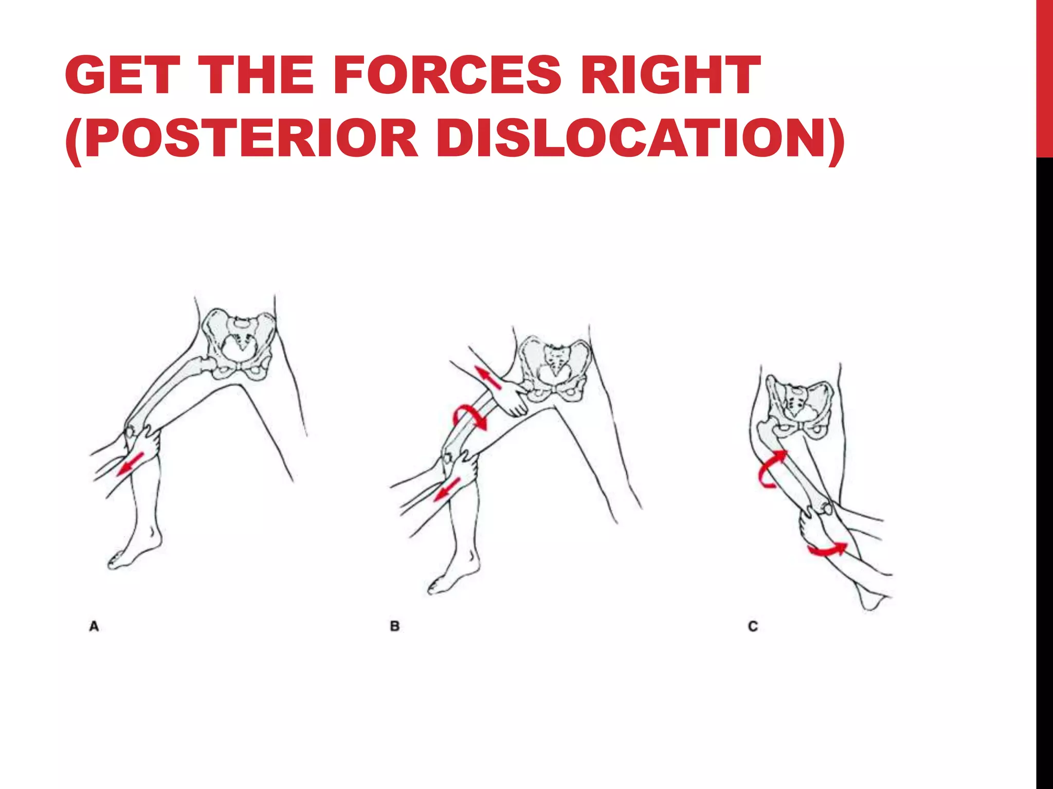 Hip Reduction Techniques | PPTX