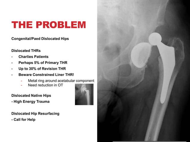 Hip Reduction Techniques | PPTX