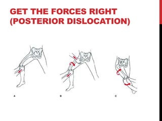 Hip Reduction Techniques | PPTX