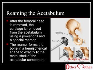 Hip replacement | PPT