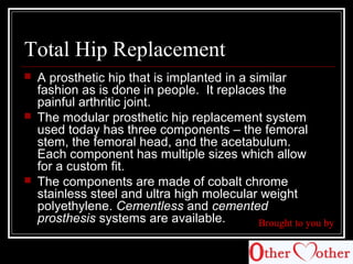Hip replacement | PPT