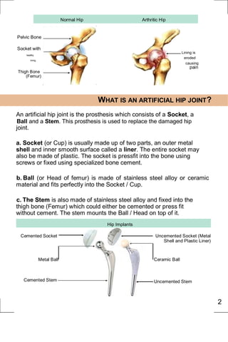 Hip Replacement Surgery Guide(English) - FAQ Answered by India's best ...