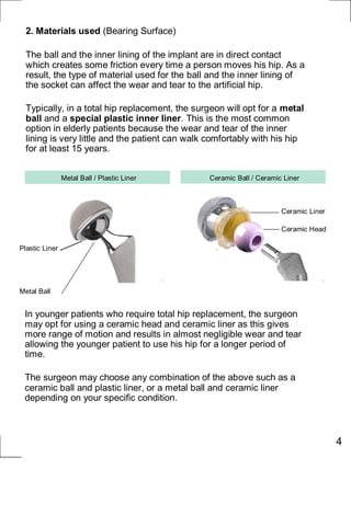 Hip Replacement Surgery Guide(English) - FAQ Answered by India's best ...