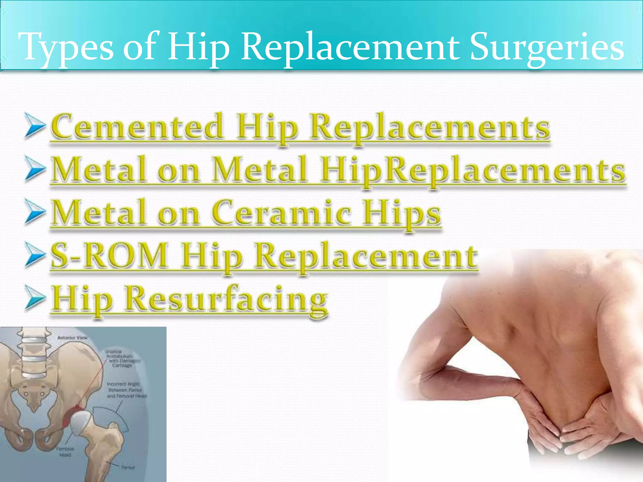 Hip replacement surgery India | PPTX
