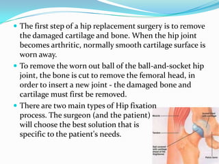Hip replacement surgery India | PPTX
