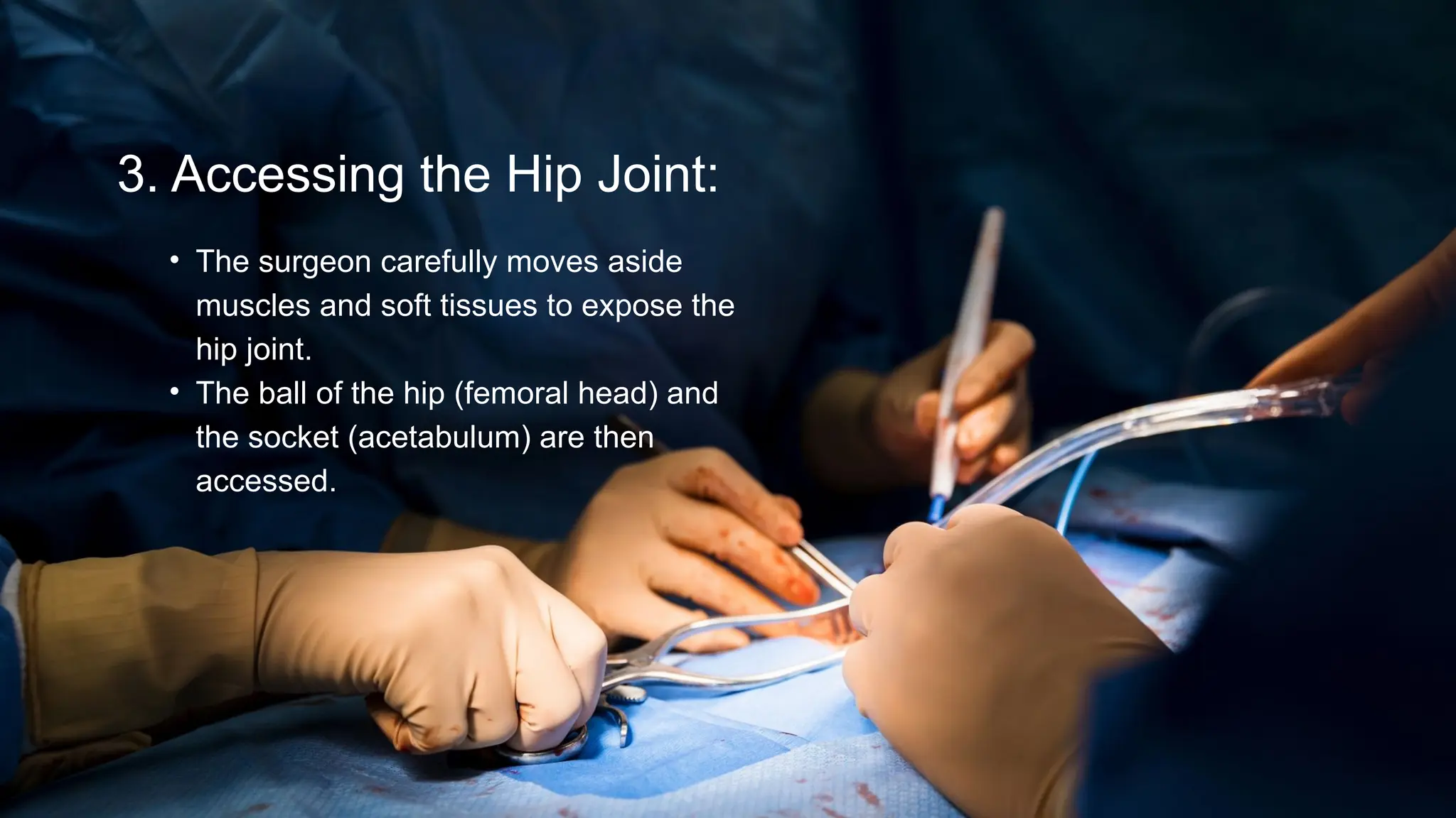 Hip Replacement Surgery Procedure-Dr Abhinav Kesarkar.pptx