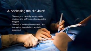 Hip Replacement Surgery Procedure-Dr Abhinav Kesarkar (1).pptx