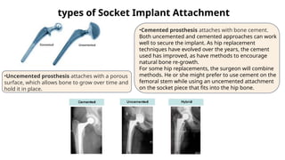 hip replacement, medicin, healthcare, surgery , | PPTX