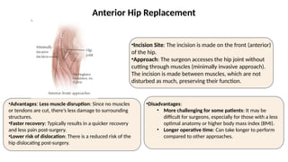hip replacement, medicin, healthcare, surgery , | PPTX