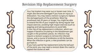 hip replacement, medicin, healthcare, surgery , | PPTX