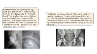 hip replacement, medicin, healthcare, surgery , | PPTX