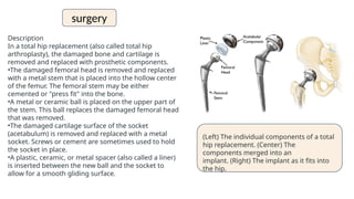hip replacement, medicin, healthcare, surgery , | PPTX