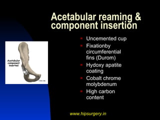 Hip resurfacing India | Dr.Venkatachalam | PPT