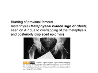 Slipped Capital Femoral Epiphysis (SCFE) | PPTX