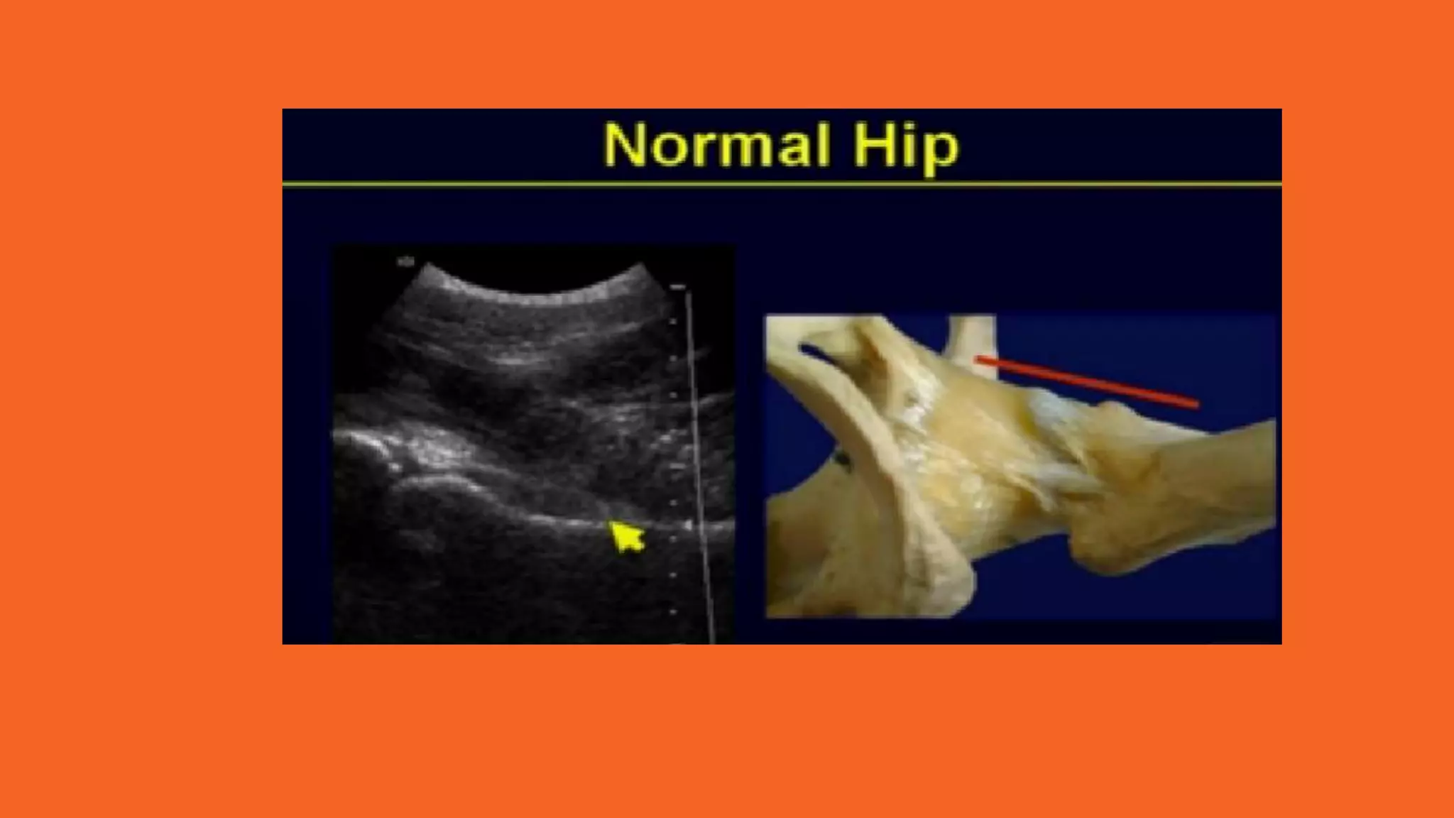 Hips ultrasound...pptx