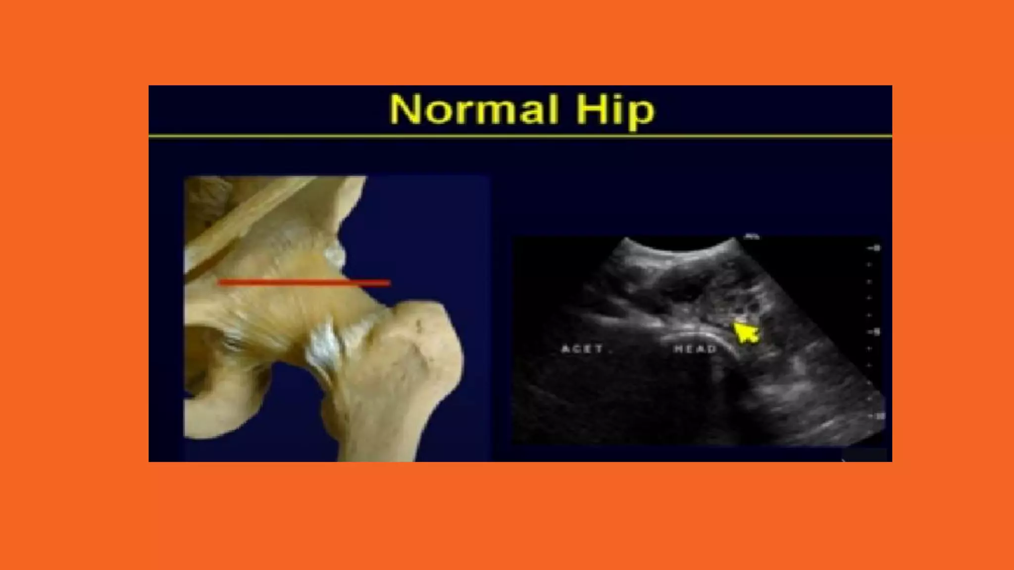 Hips ultrasound...pptx