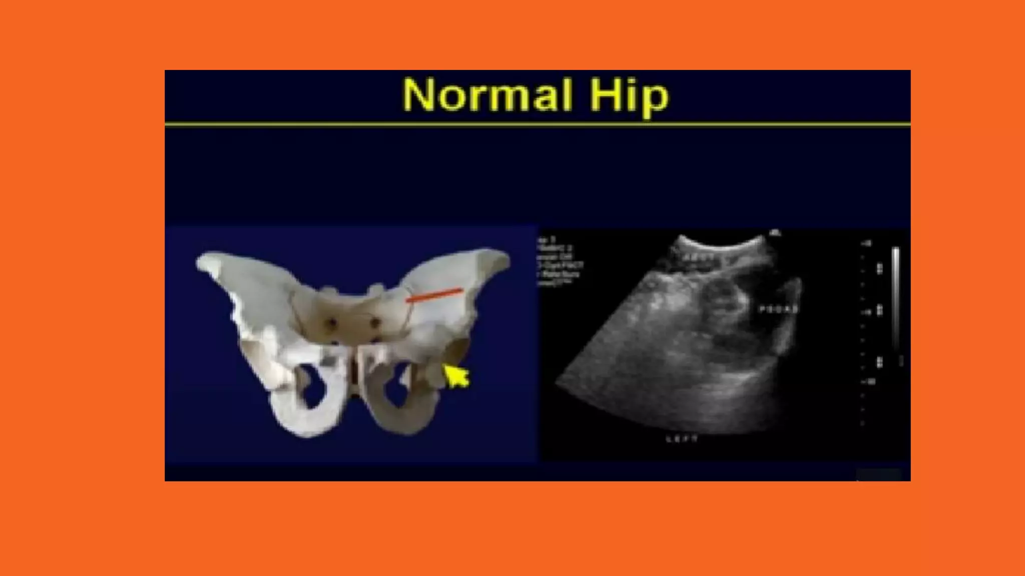 Hips ultrasound...pptx