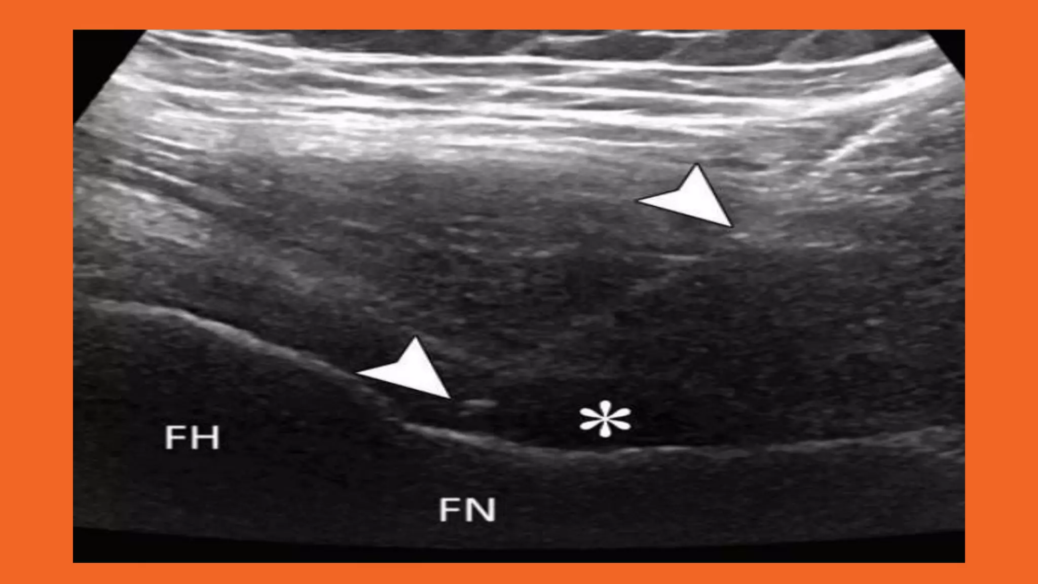 Hips ultrasound...pptx
