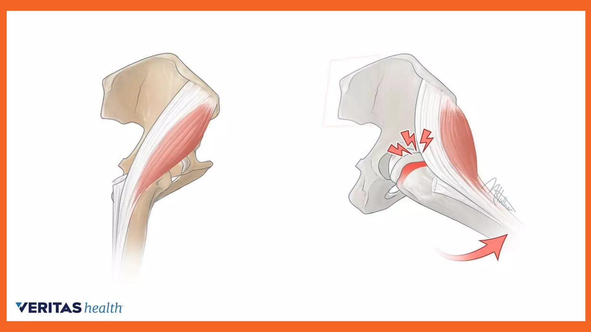 Hips ultrasound...pptx