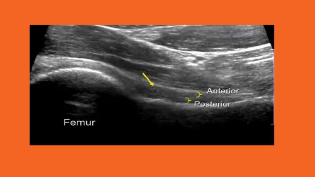 Hips ultrasound...pptx