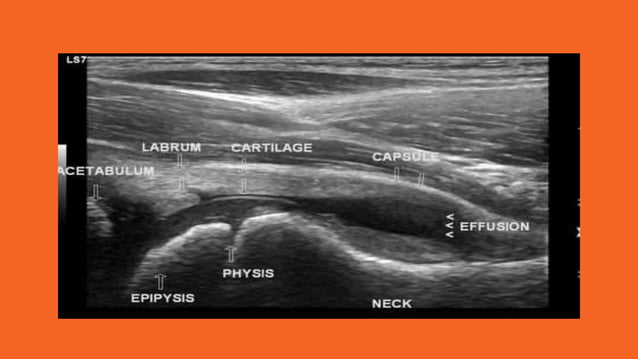 Hips ultrasound...pptx
