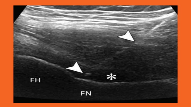 Hips ultrasound...pptx