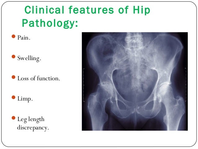Clinical Examination of Hip
