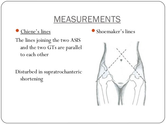 Clinical Examination of Hip