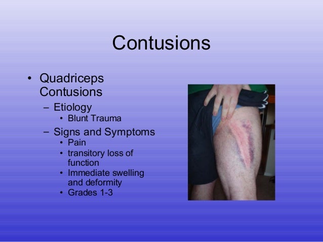 Quadriceps Strain Contusions Assessment Diagnosis