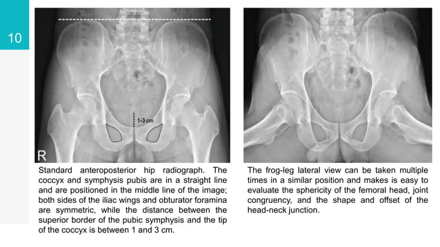 HIP X-RAY.pptx