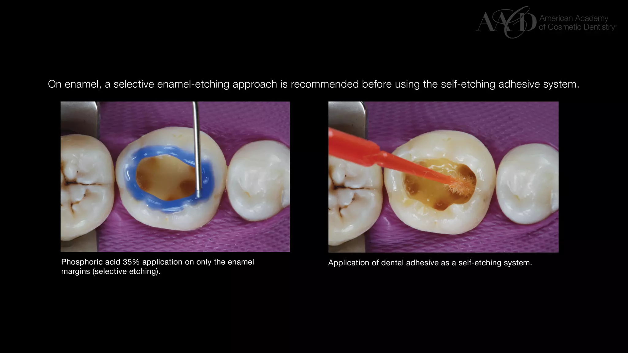 Traditional Layering vs. Modified Bulk Filling | PPT