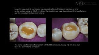 Traditional Layering vs. Modified Bulk Filling | PPT