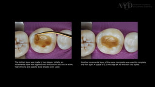 Traditional Layering vs. Modified Bulk Filling | PPT